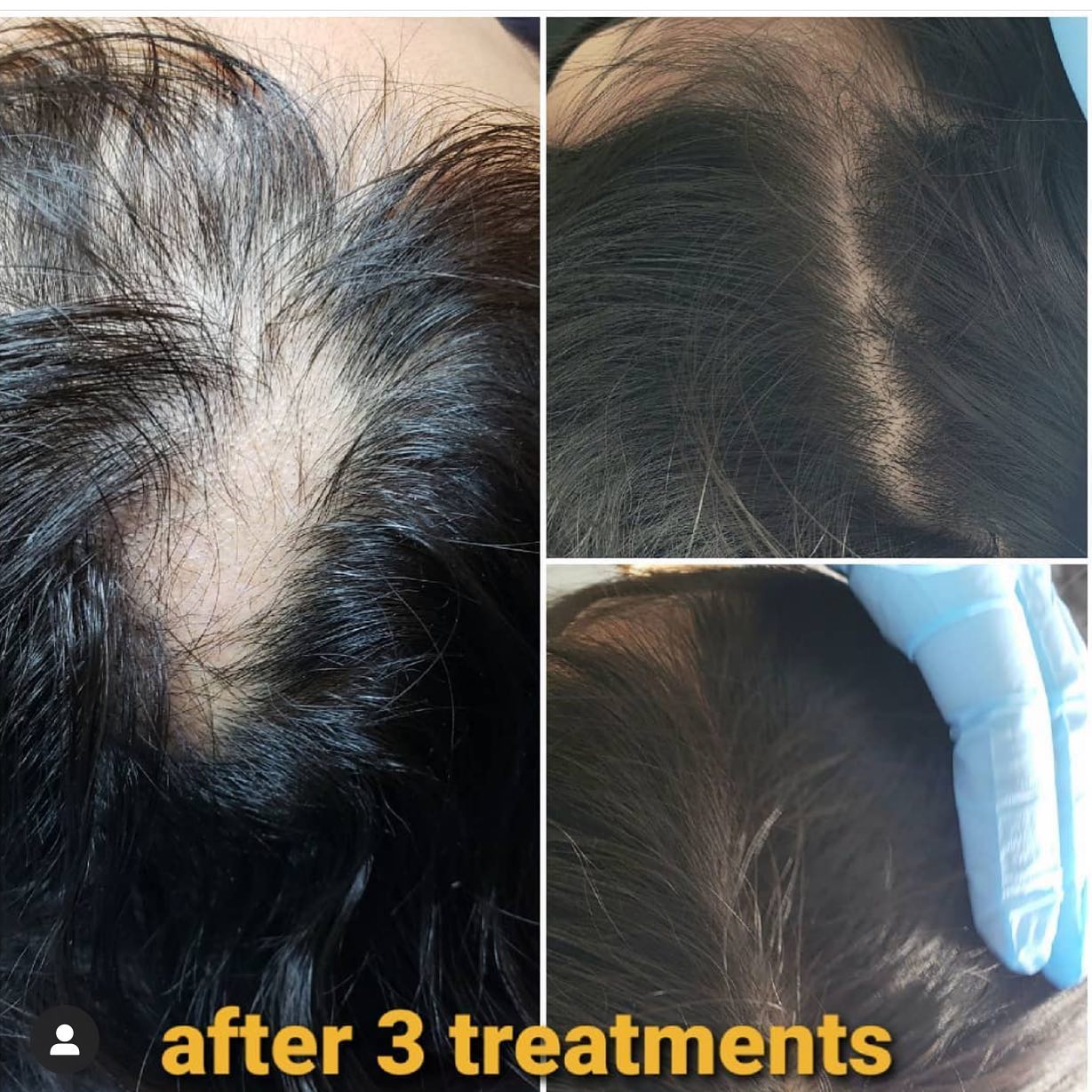 Scalp Micropigmentation Chicago | Hair Tattoo Chicago & Beard ...